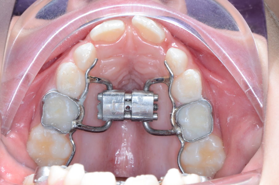 L'espansore palatale: tutto ciò che vorresti sapere - Studio dentistico ...