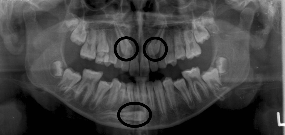 Canini Inclusi - Studio dentistico dott.ssa Federica Ercoli